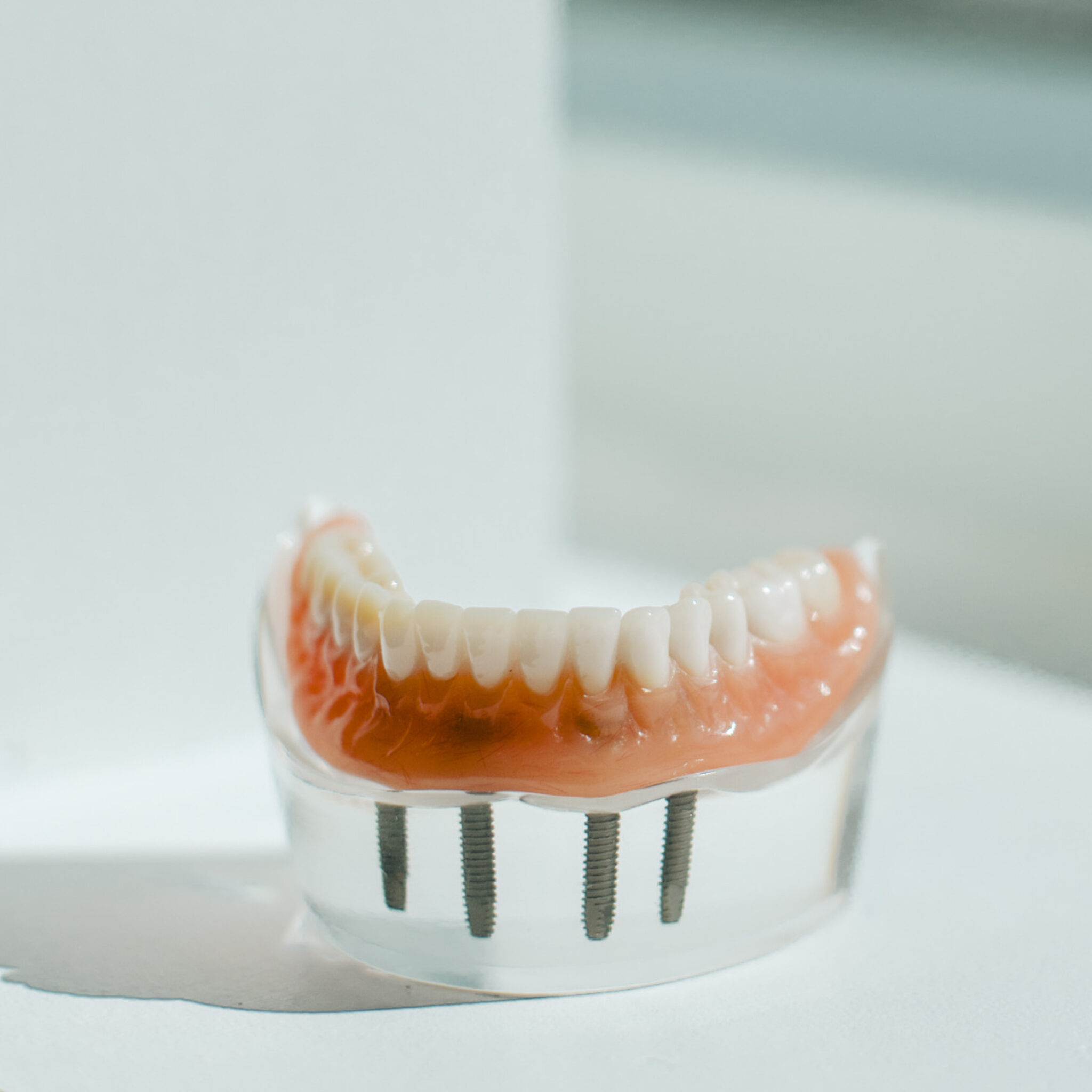 Implant-supported Bridge: All You Need to Know - Honce Dentistry